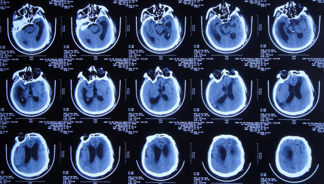Hydrocephalus after craniocerebral trauma, skull repair caused ...