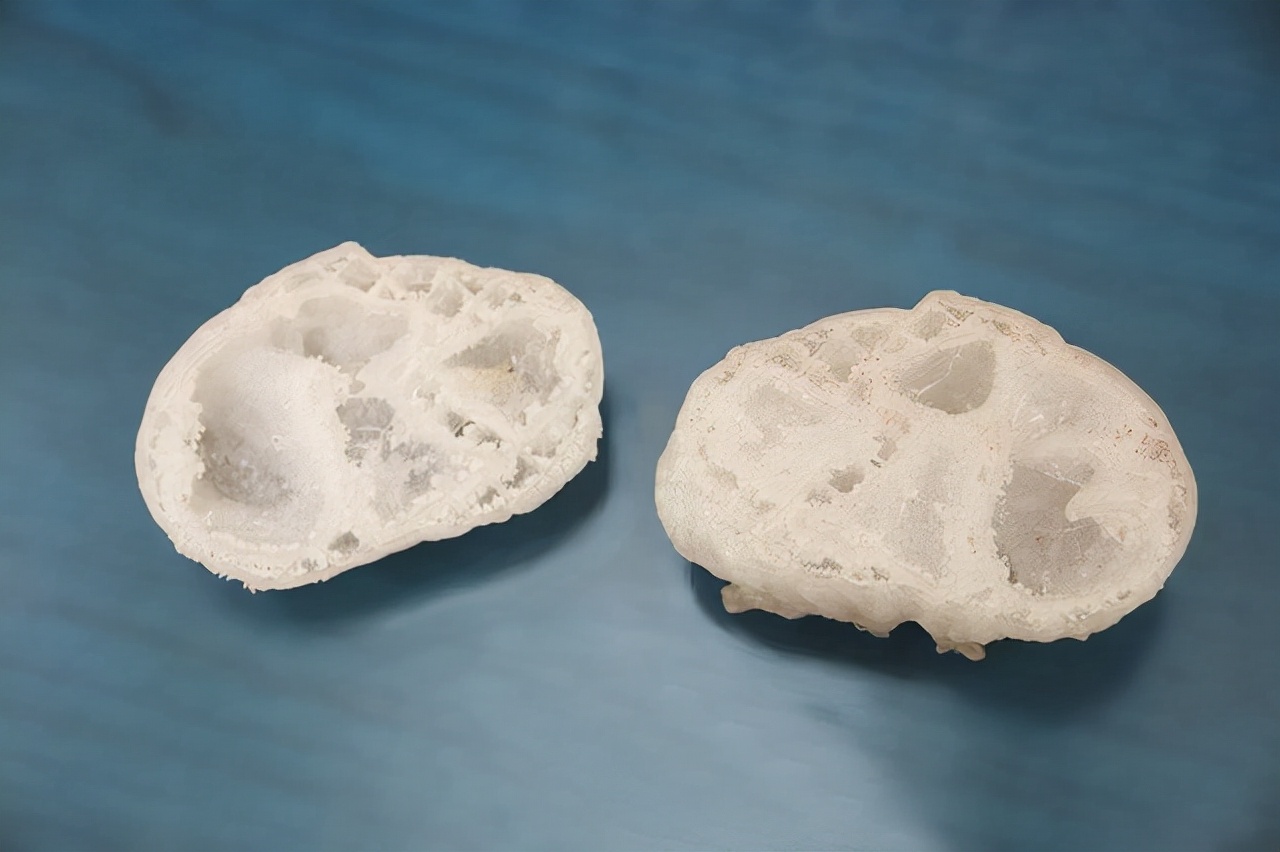 New composite material accelerates the recovery of damaged bones - iNEWS