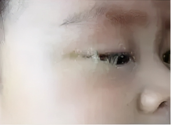 This kind of congenital eye disease can easily lead to dacryocystitis ...