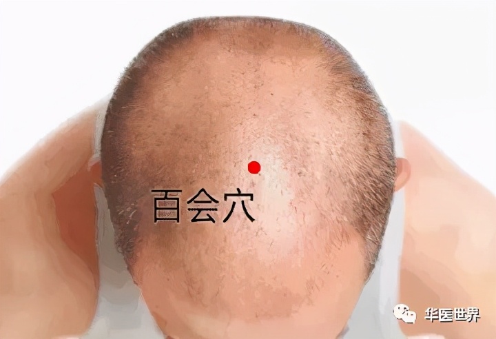 Treatment of cervical spondylosis with 2 acupoints, Wen Tong Du Channel ...