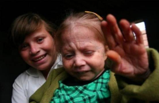 How terrible is Progeria?A 16-year-old woman from the Philippines grows ...