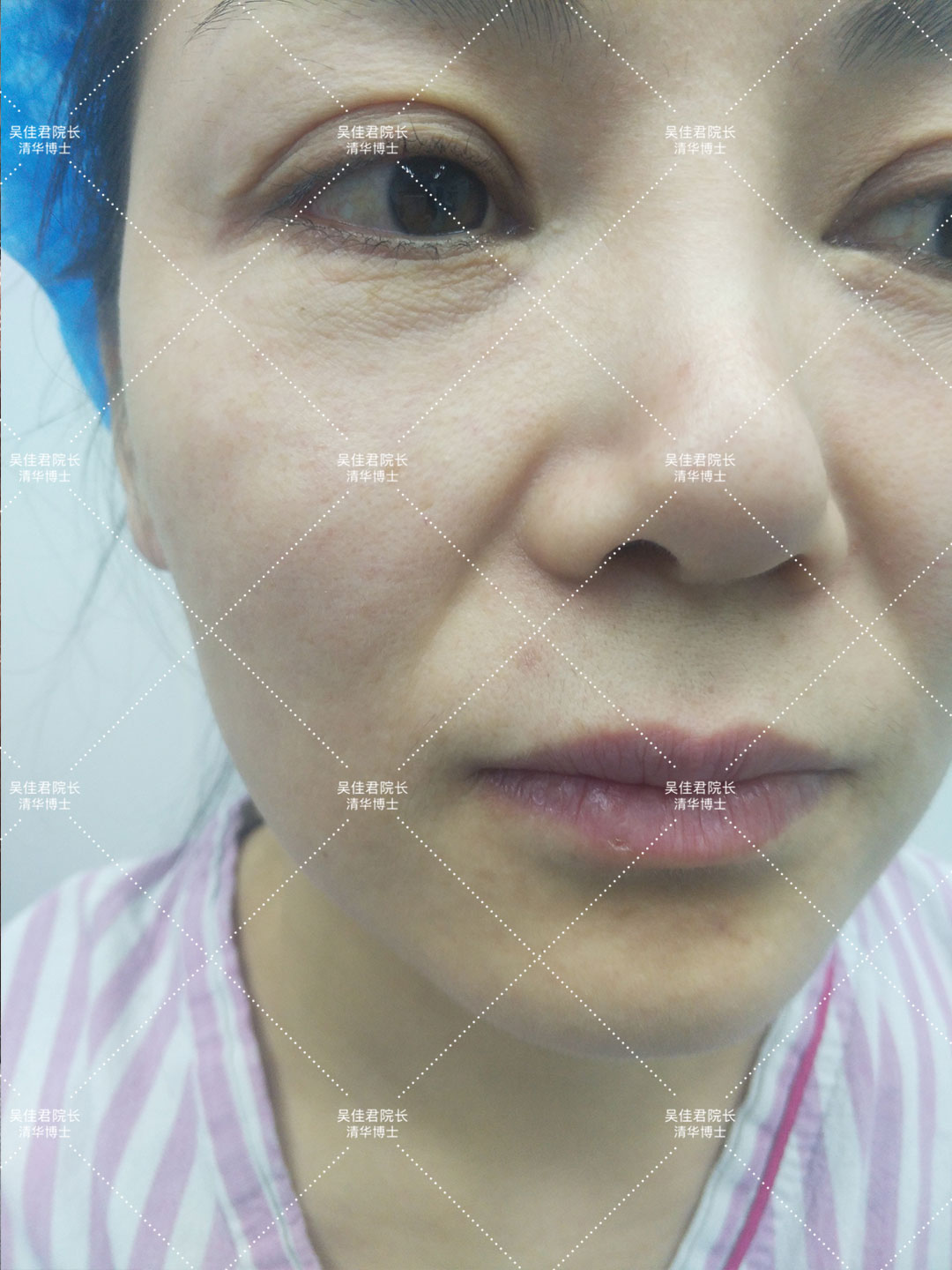 In her 30s, her face collapsed like a 50-year-old aunt. She ...