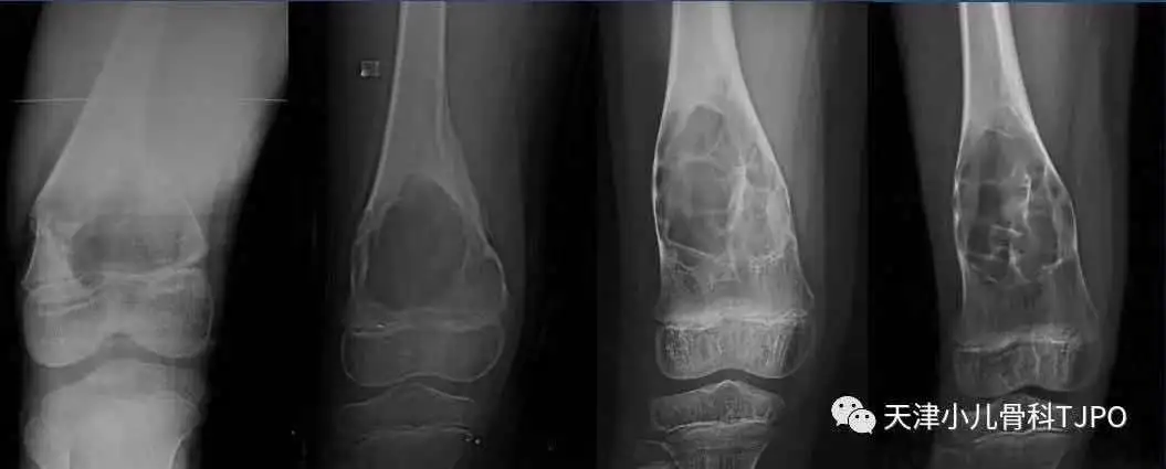 Simple bone cysts in children: how to choose a personalized treatment ...