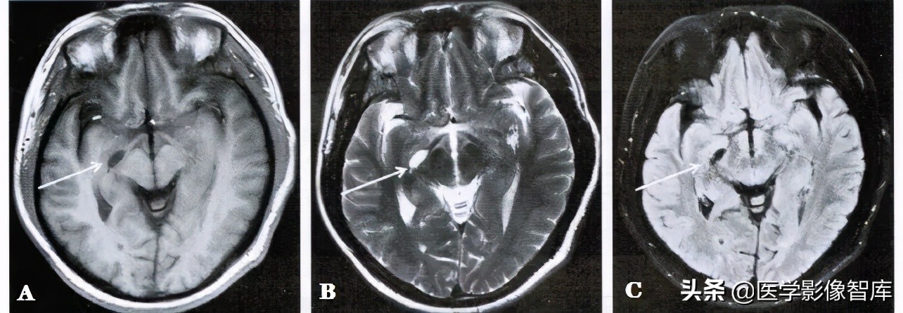 Imaging diagnosis of choroidal fissure cyst - iNEWS