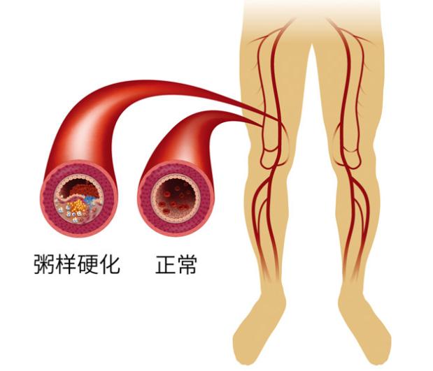 "Science" to understand diabetic lower extremity arteriosclerosis ...