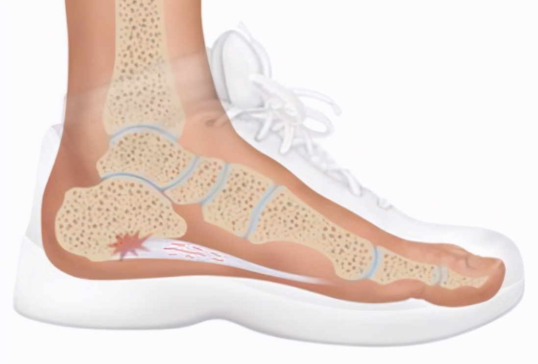 Plantar pain in your 40s, the worst since walking? It may be plantar ...