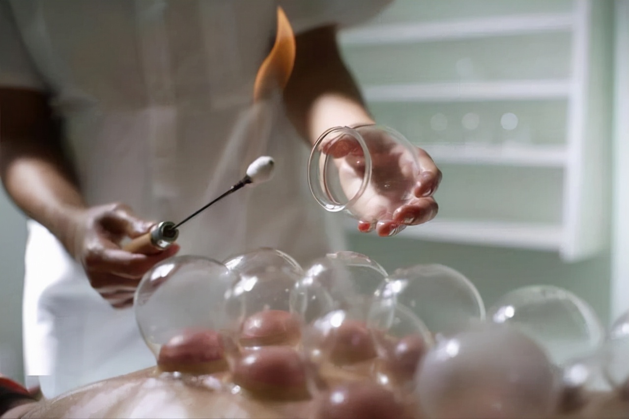 When cupping, the blood that is sucked out is the toxin in the body?The ...