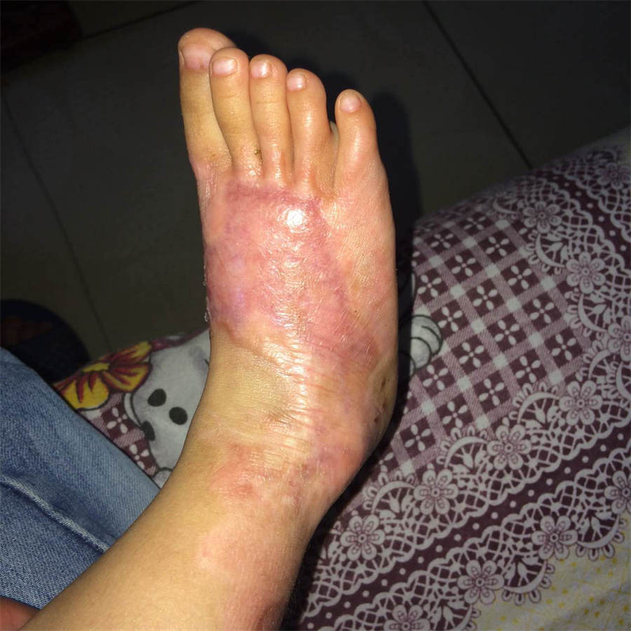 The child was scalded by boiling water unintentionally, and the mother ...