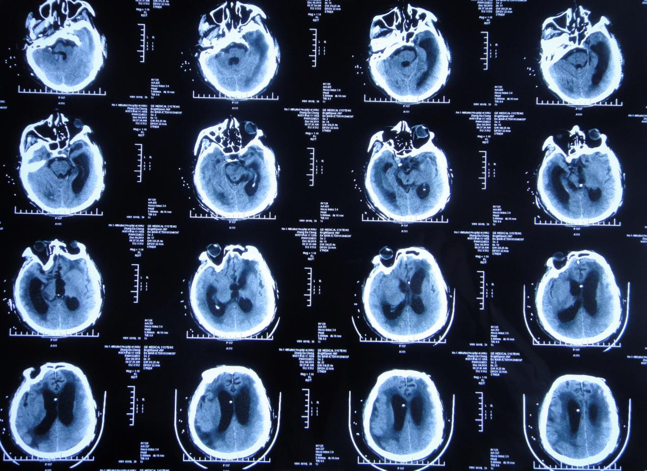 Hydrocephalus after craniocerebral trauma, skull repair caused ...