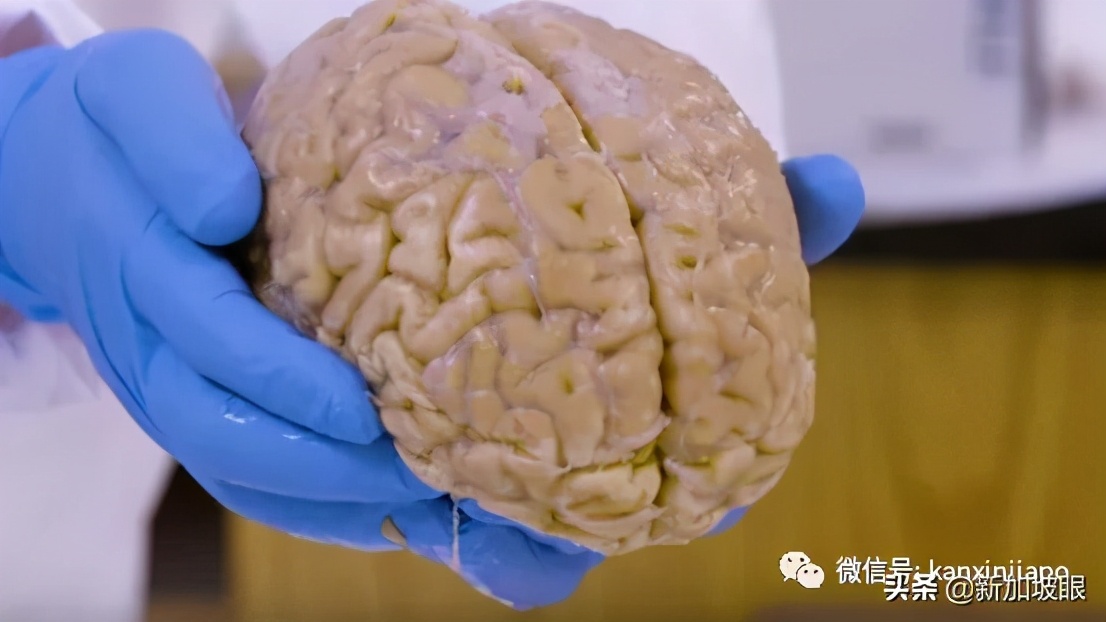 Donate your head? Singapore Brain Bank welcomes two spontaneously ...