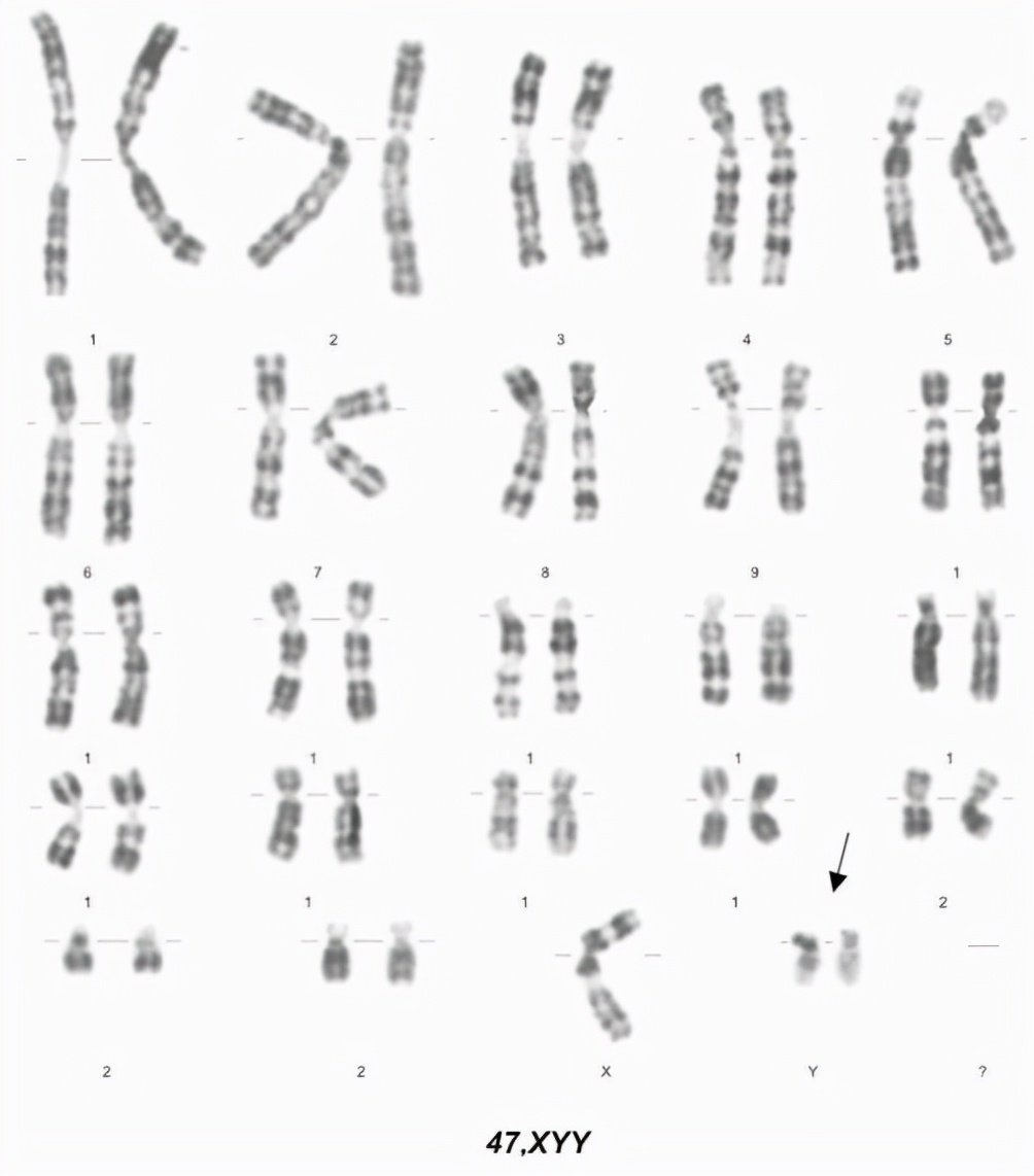 What happens if a man has an extra Y chromosome?1 in 1,000, more man ...