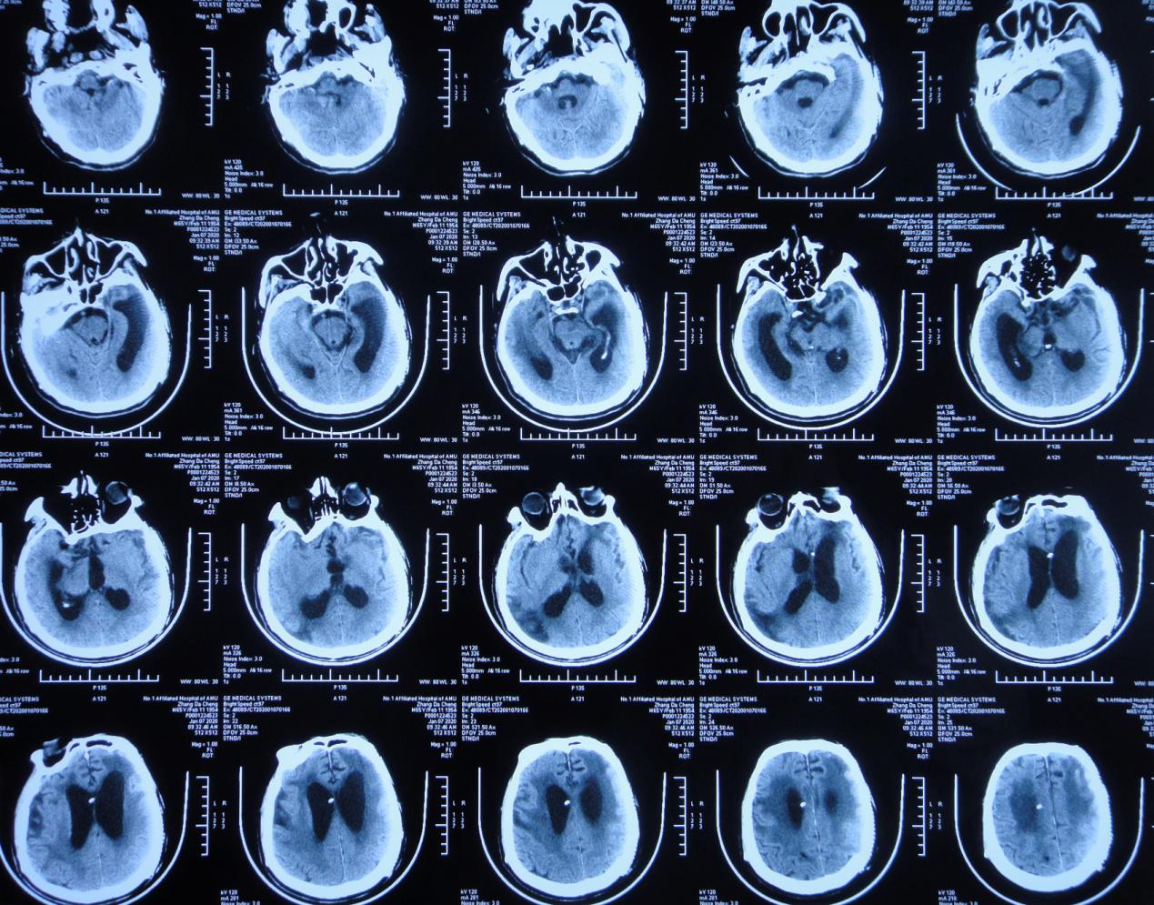 Hydrocephalus after craniocerebral trauma, skull repair caused ...