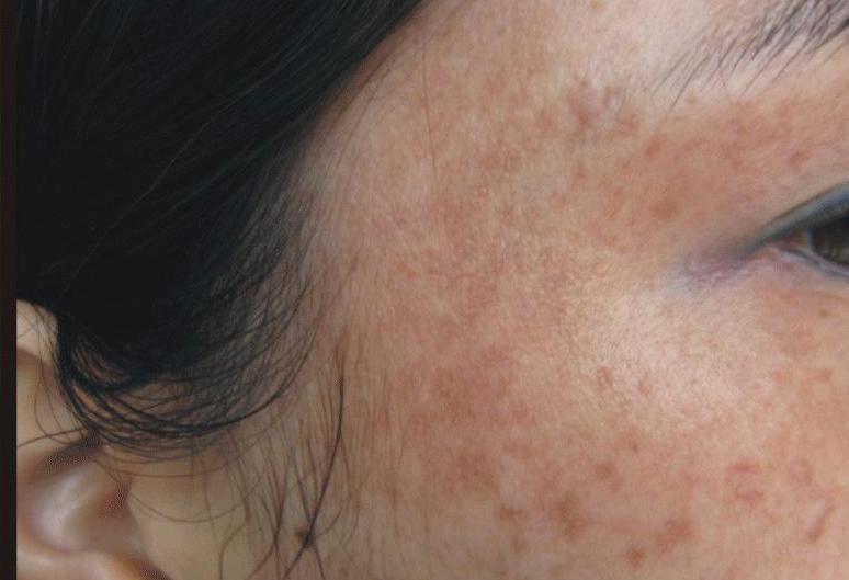 Melasma is actually a sign of chronic liver disease?The cause of ...