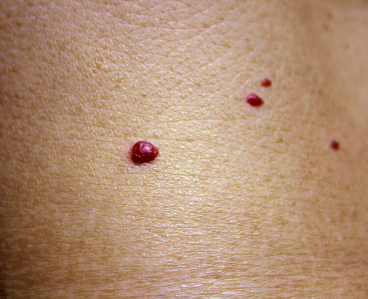 What are the small meat balls and small meat bumps on the skin? Not ...