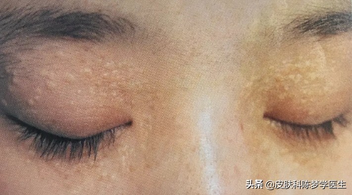 Dozens of "small meat balls" grow on the neck. Are they filiform warts ...