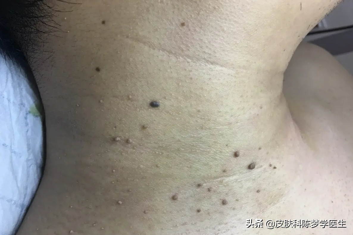 Dozens of "small meat balls" grow on the neck. Are they filiform warts ...