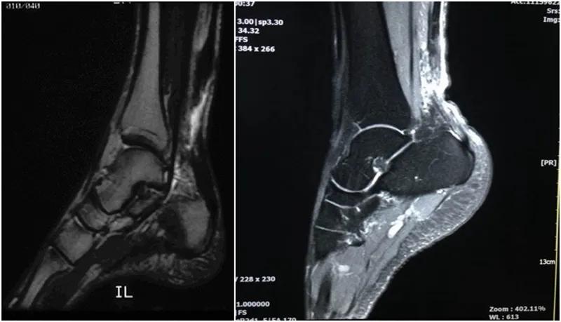 Diagnosis and treatment strategies for Achilles tendon rupture - iNEWS