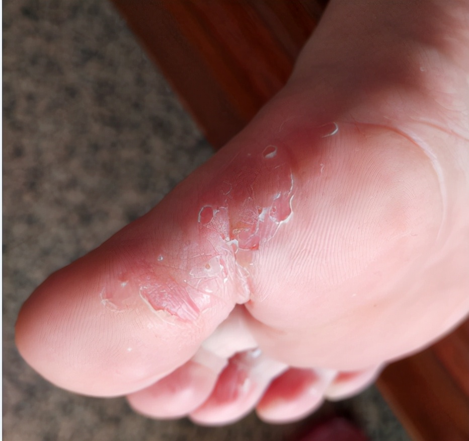 Hand, foot and ringworm repeatedly annoying - iNEWS