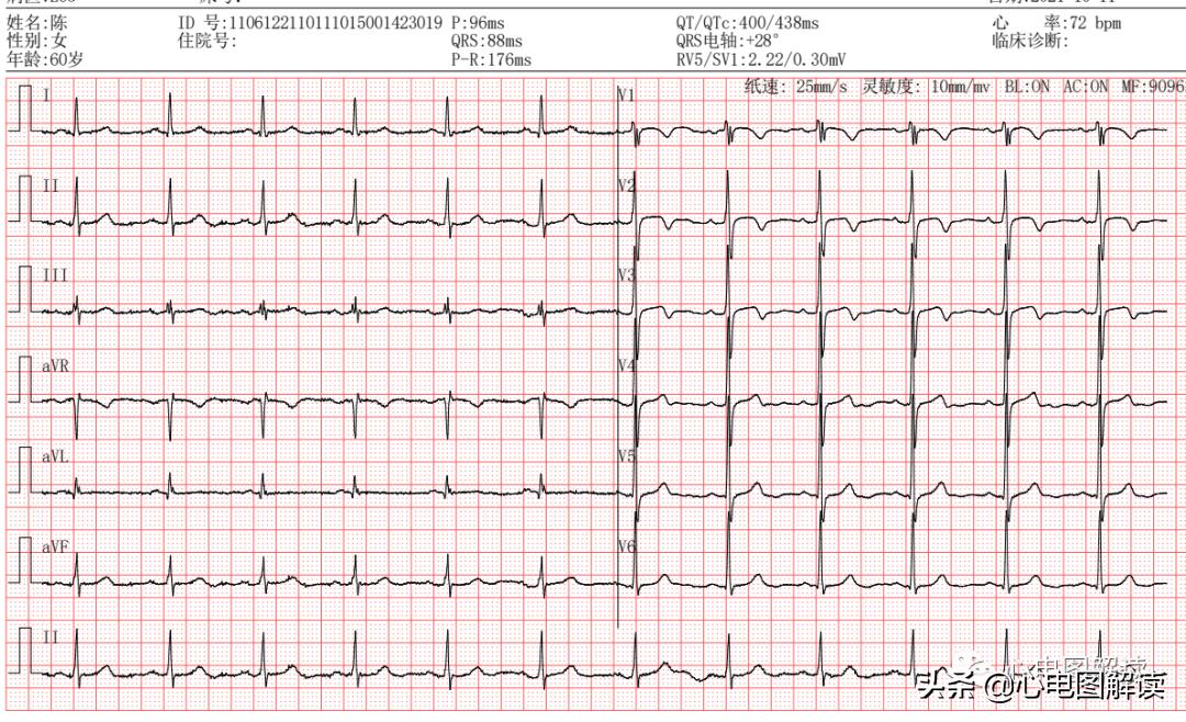 Narrow fragmentation QRS wave?Incomplete right bundle branch block? - iNEWS