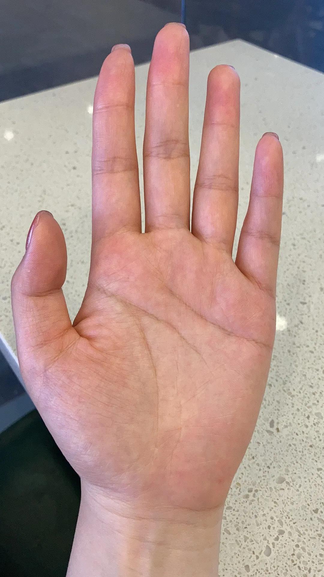 Hand diagnosis analysis/*/The little finger is short, curved, and ...
