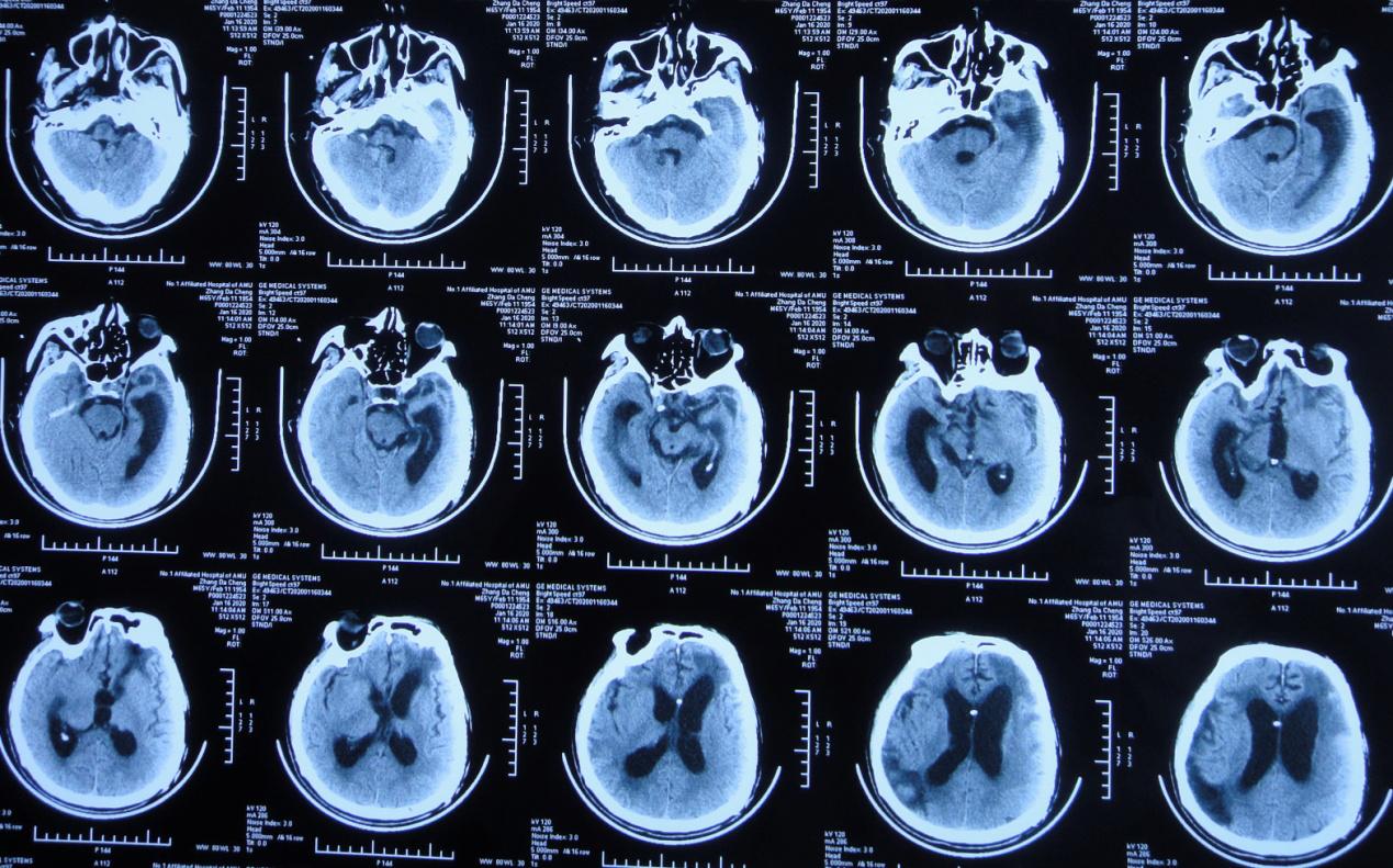 Hydrocephalus after craniocerebral trauma, skull repair caused ...