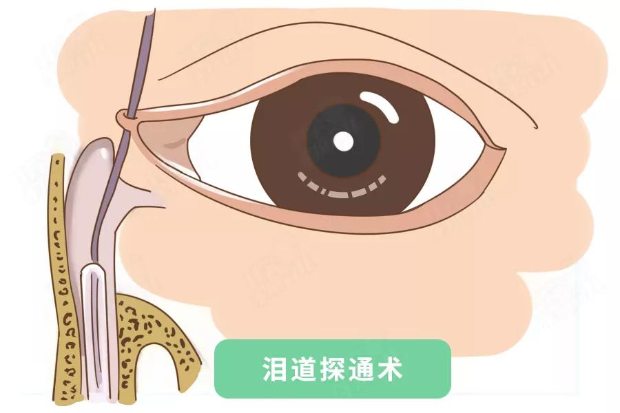 This kind of congenital eye disease can easily lead to dacryocystitis ...
