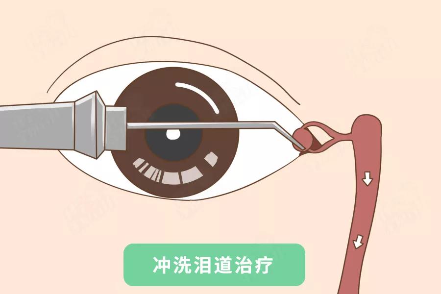 This kind of congenital eye disease can easily lead to dacryocystitis ...