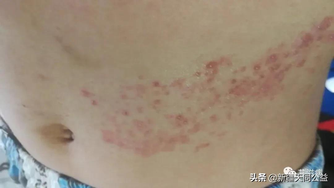 What exactly does the AIDS "red dot" rash look like? - iNEWS