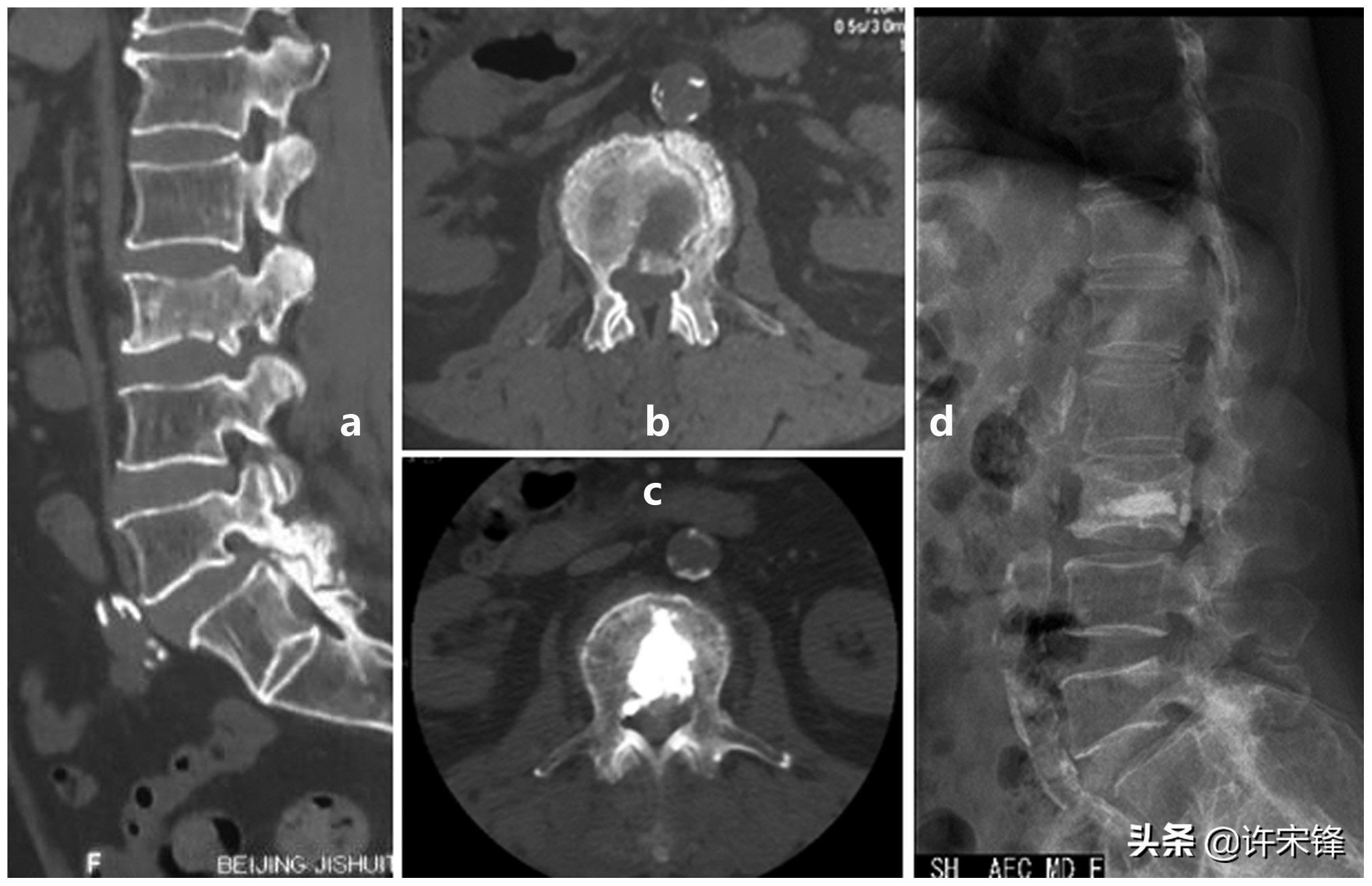 2021 SCI Article Minimally Invasive Treatment of Osteogenic Spinal ...