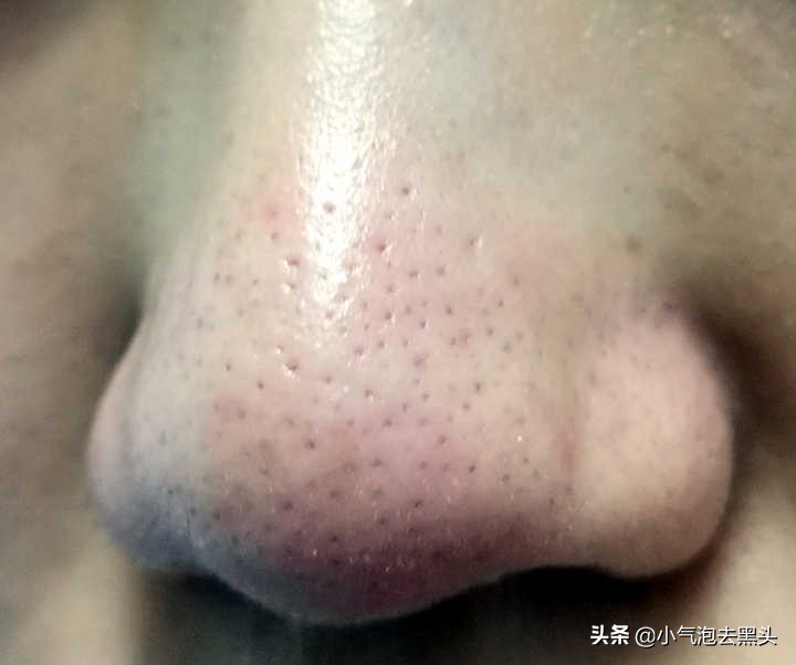 What are the types of strawberry nose? - iNEWS