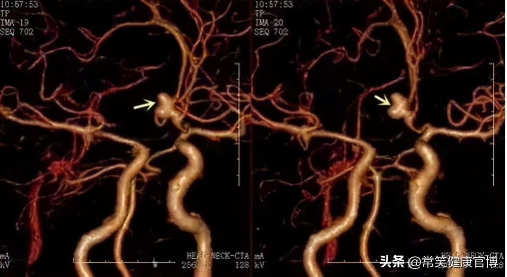 Do you really know stroke?What is the difference between CTA and CT ...