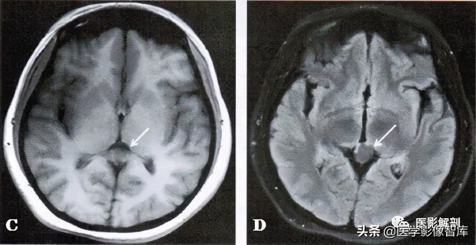 Imaging diagnosis of pineal cyst - iNEWS