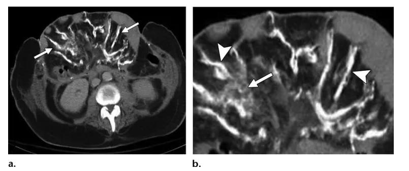 Calcification in the abdominal and pelvic cavity?These differential ...