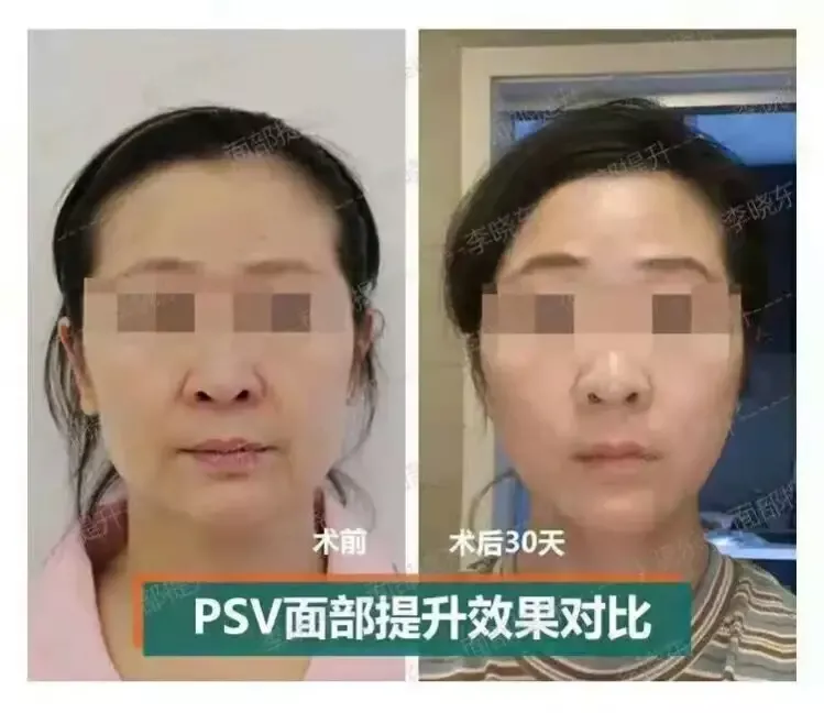 What is the difference between PSV face lift and face lift?Where is the ...