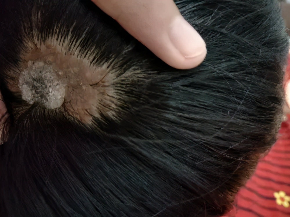 Suffering from sebaceous nevus really affects your appearance, but don ...