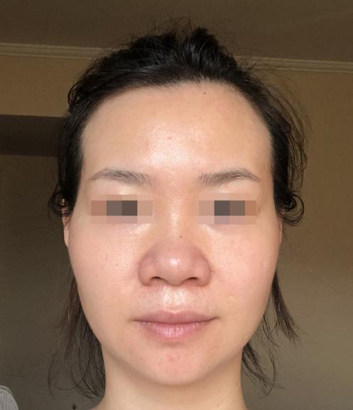 Sunken temples, big nose, full face transformation and new look - iNEWS