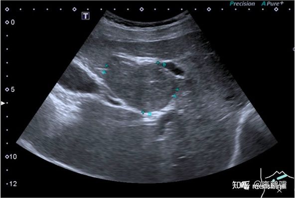 What is FNH (focal nodular hyperplasia of the liver) - iNEWS