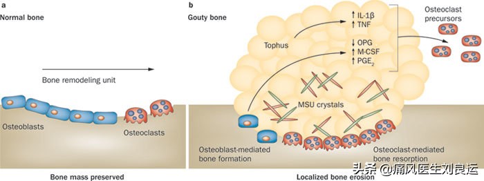 Do gout patients all grow tophi?The doctor introduces four methods of ...