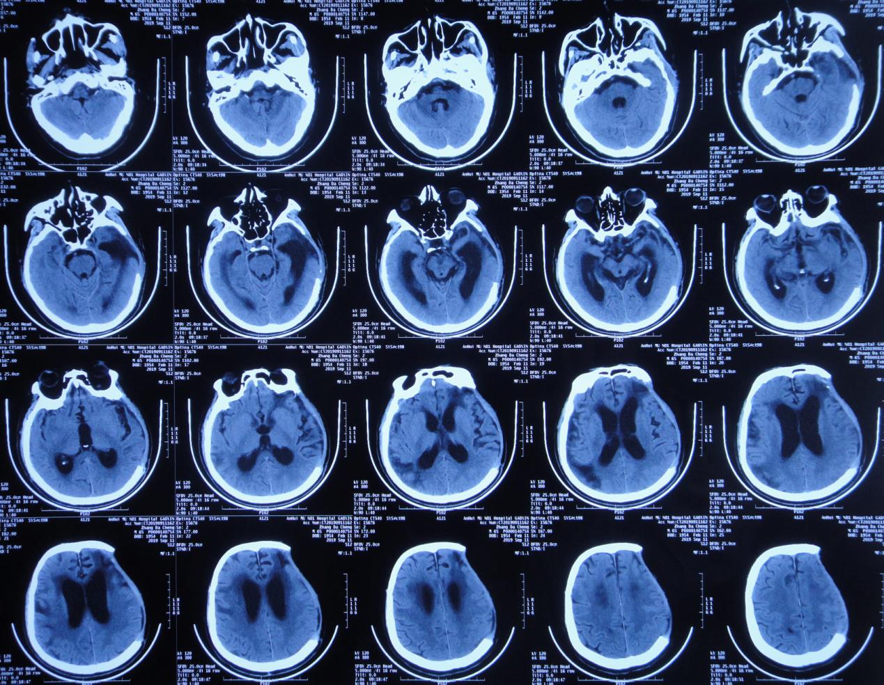 Hydrocephalus after craniocerebral trauma, skull repair caused ...