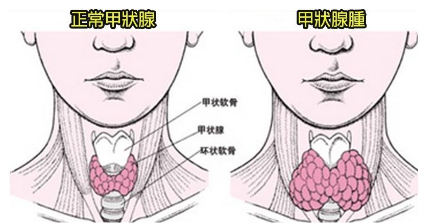 Is it better to choose minimally invasive surgery for thyroid surgery ...
