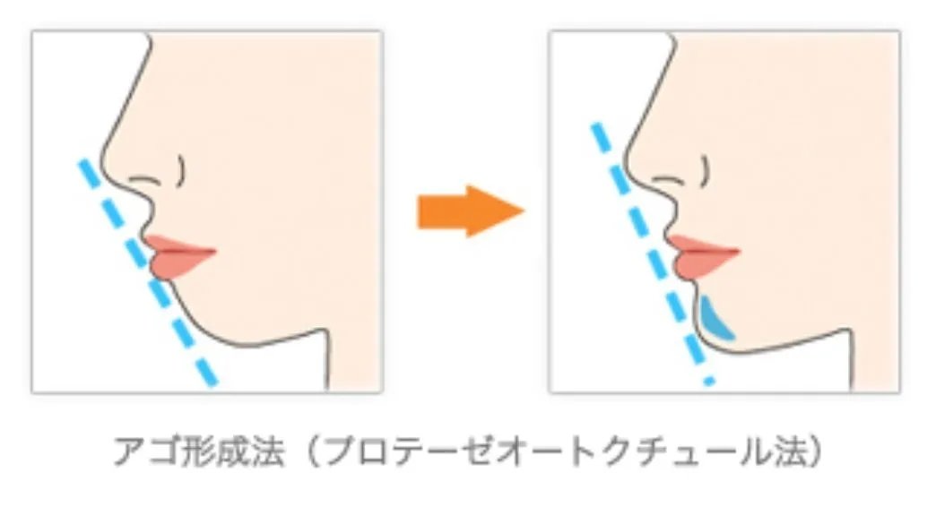 No matter how delicate the facial features are, and the chin is not ...