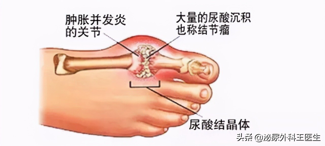 These 3 symptoms appear when you get up, indicating that the uric acid ...