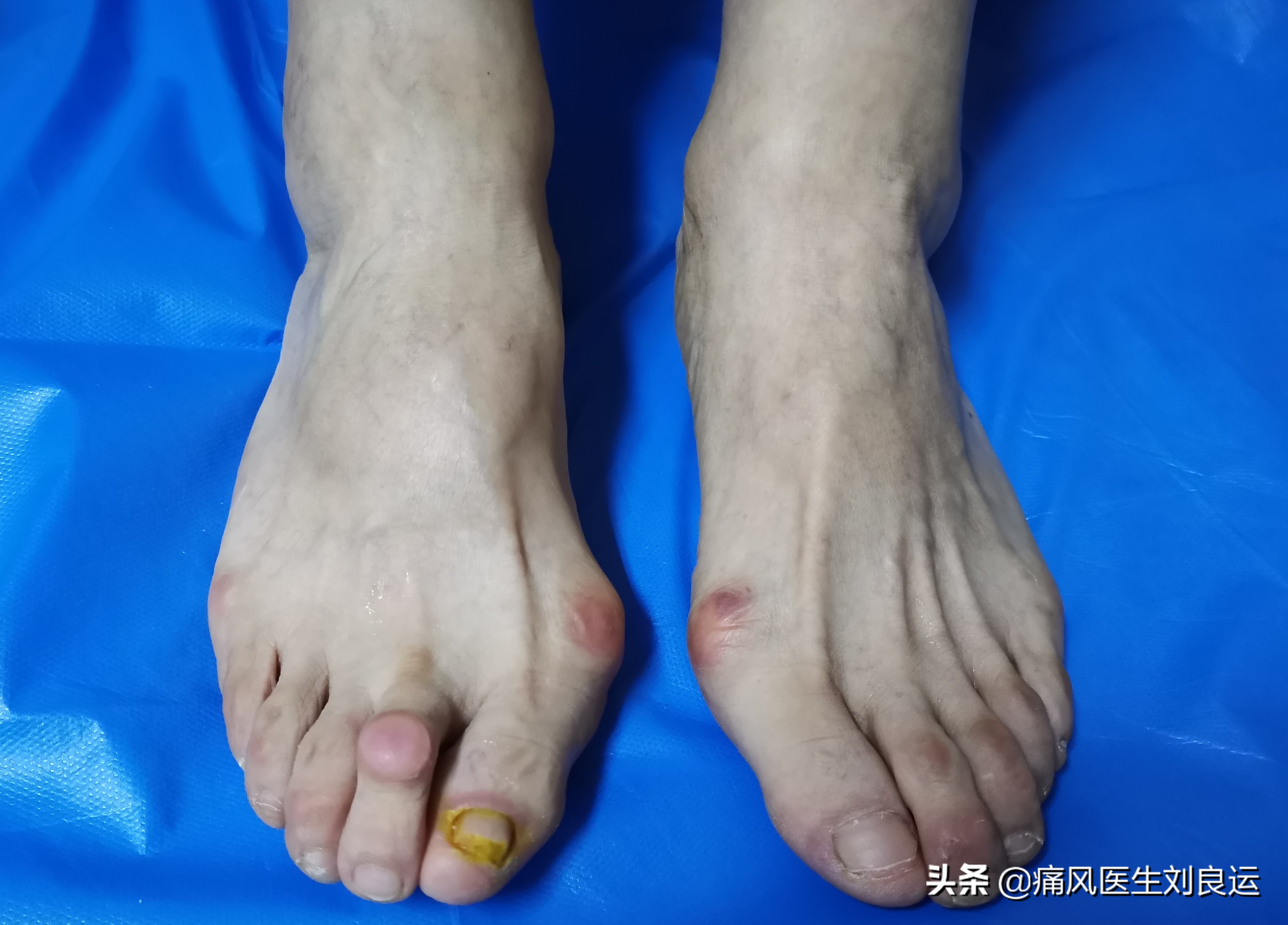 Do gout patients all grow tophi?The doctor introduces four methods of ...
