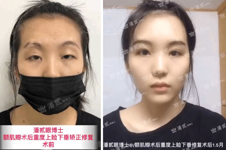 After cutting the double eyelids, the eyebrows are too close to the ...