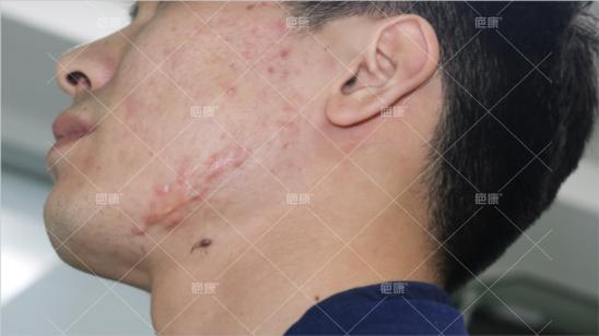 (Scar Kang) If your acne doesn't go down for a long time - iNEWS