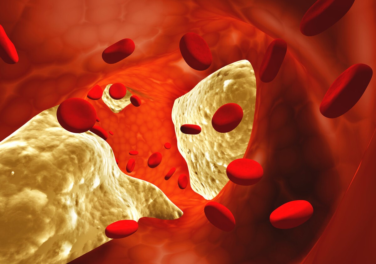 The "soft plaque" in the carotid artery is highly unstable, but the ...