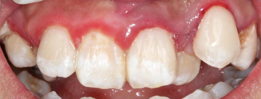 Tooth defect caused by cola, doctor: fortunately it came in time - iNEWS