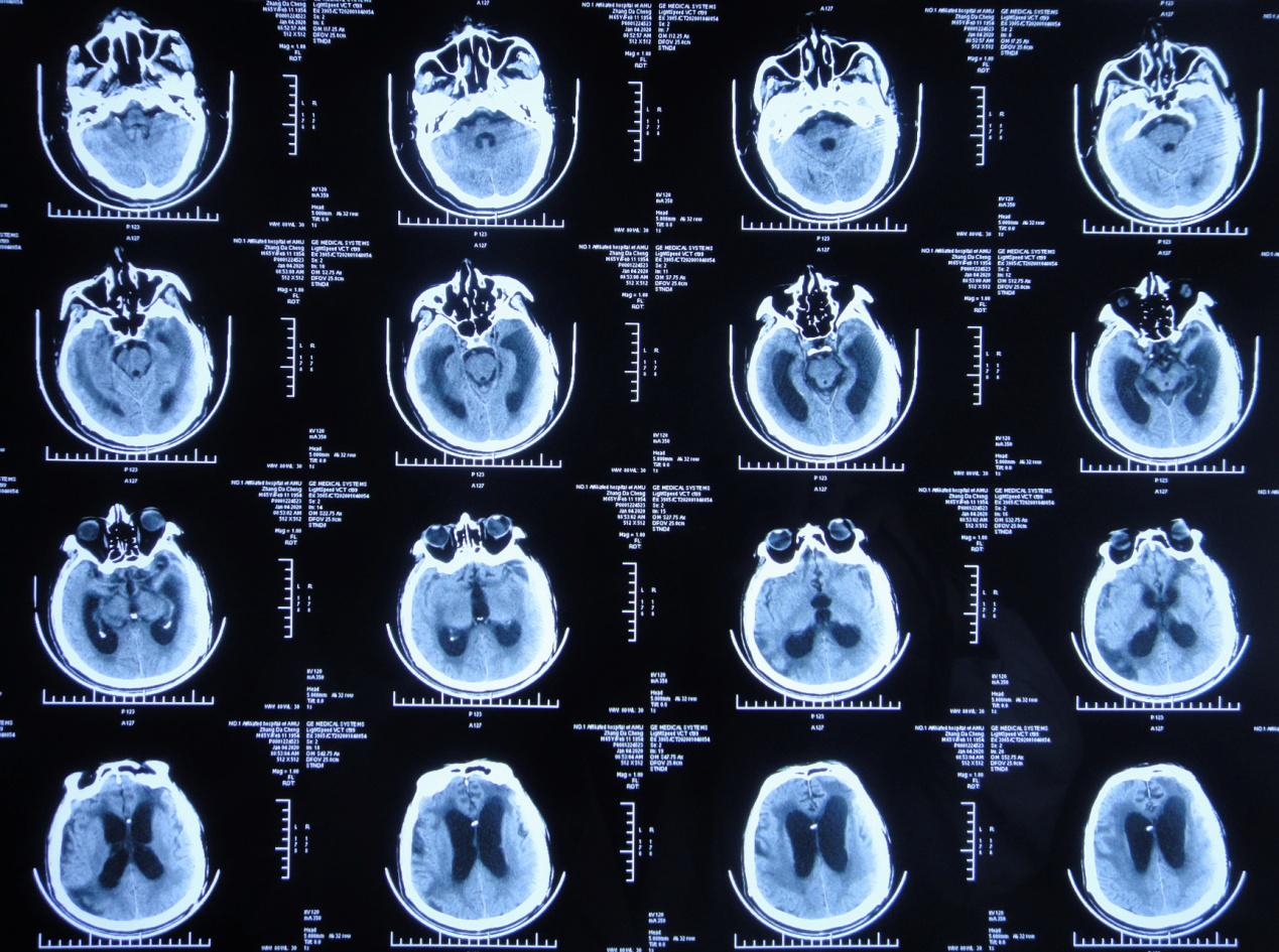 Hydrocephalus after craniocerebral trauma, skull repair caused ...