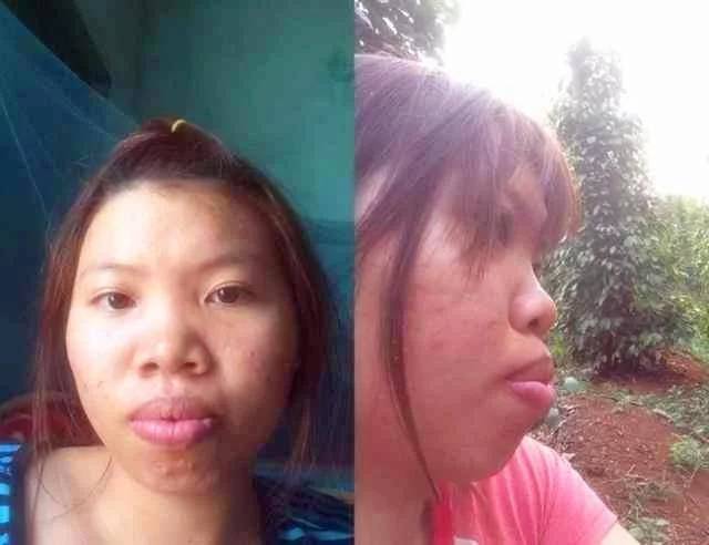 The ugly woman in Thailand spent 150,000 yuan on plastic surgery, and ...
