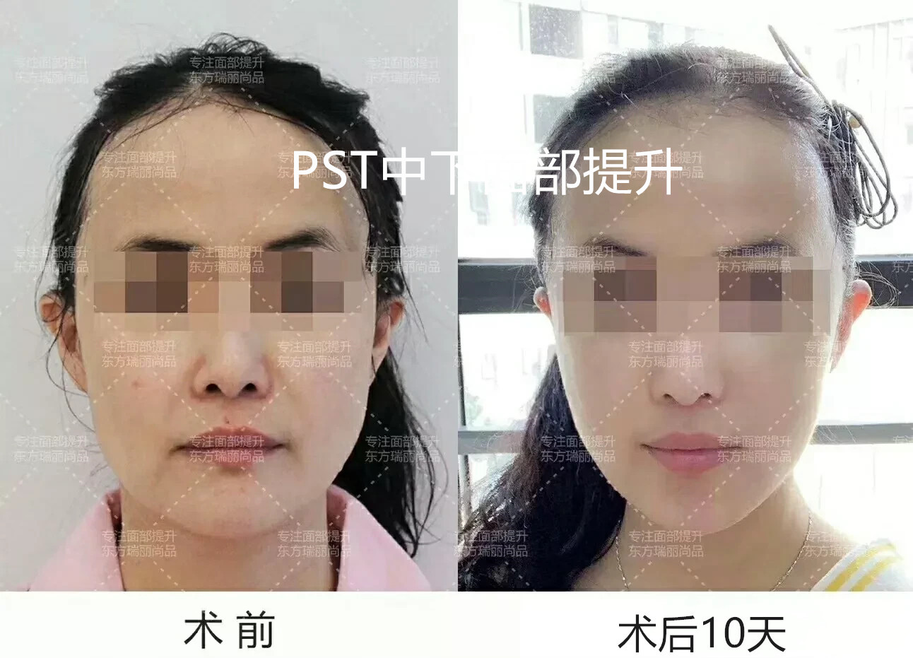 What are the advantages of PST facial lift compared to traditional ...